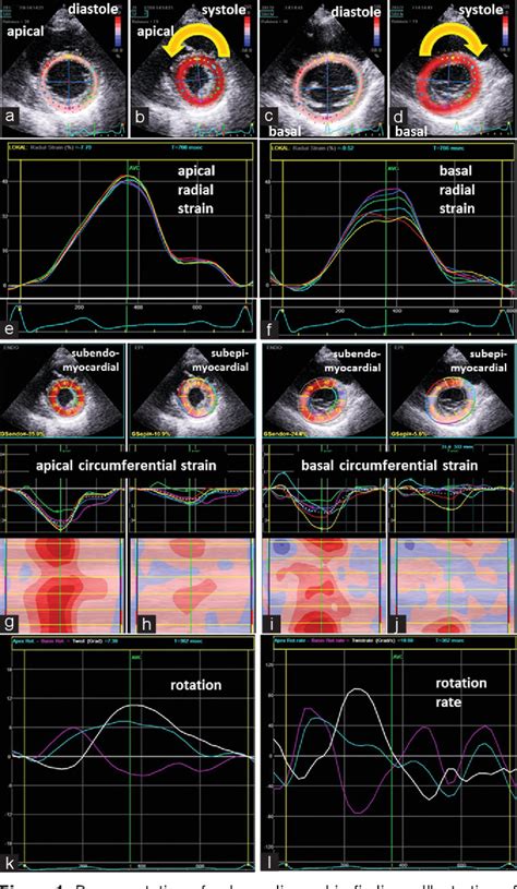 Figure 1 From Myocardial Work A Modern Tool To Detect Possible