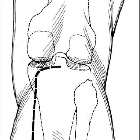 Pdf Posterior Coronal Plating Of Bicondylar Tibial Plateau Fractures