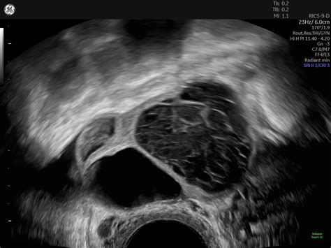 Bowel Endometriosis Ultrasound Allows Accurate And Efficient Diagnosis