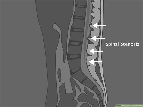 Normal Vs Abnormal Mri Lumbar Spine