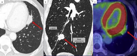 Radiological Imaging Findings A B Computed Tomography Ct Shows A Download Scientific