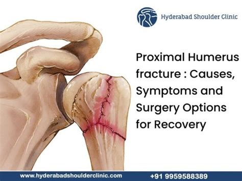Proximal Humerus Fracture Causes Symptoms And Surgery Options For Recovery Shoulder Clinic