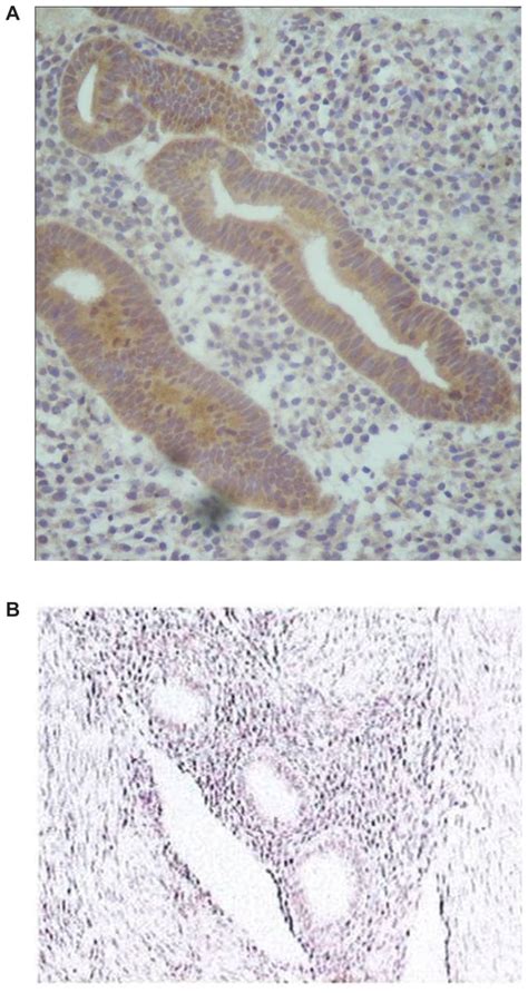Positive Aromatase Expression In The Eutopic Endometrium Of A Patient