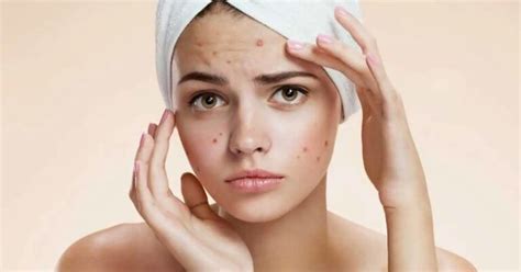 Icd 10 Codes For Acne Complete Dermatology Guide