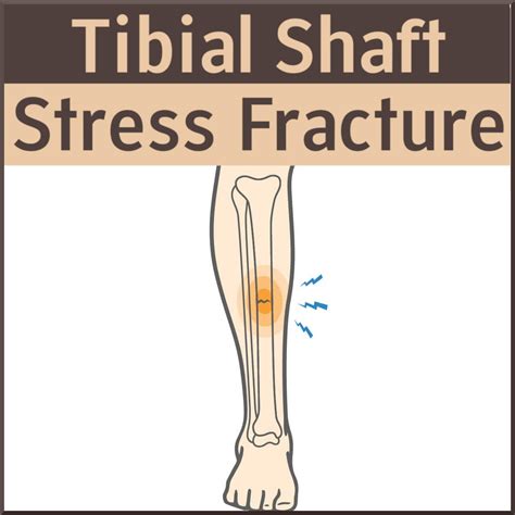 Stress Fracture Tibia Bone Scan