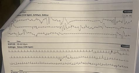 What Does This Holter Reading Mean Rpvcs
