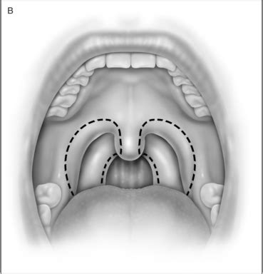 Uvulopalatopharyngoplasty Effects On The Airway Pocket Dentistry