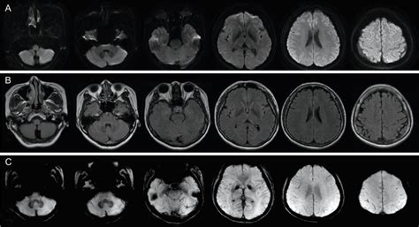 Diffusion Weighed Imaging A Fluid Attenuation Inversion Recovery