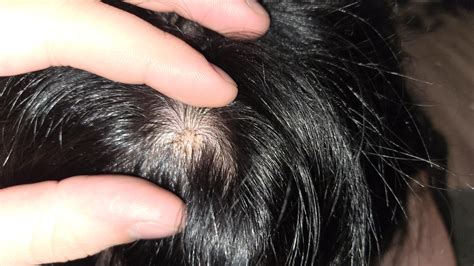 Scalp Bump Rdermatologyquestions