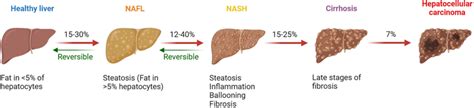 Nafl Spectrum During Development And Progression In Healthy Livers