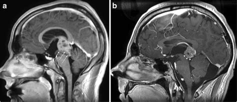 Midbrain Extension And Midbrain Compression A Sagittal Post Contrast