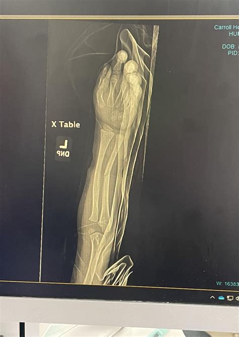 Todays Break R Xrays