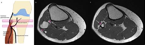 Peroneal Nerve Entrapment Mri