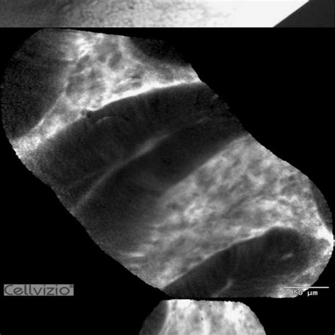 A Endoscopic Appearance Of A Slightly Raised Lesion Iia Paris