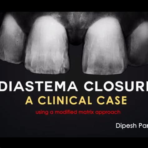 Diastema Closure Renamel With Dipesh Parmar Enlighten Smiles Blog