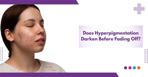 Does Hyperpigmentation Darken Before Fading Off