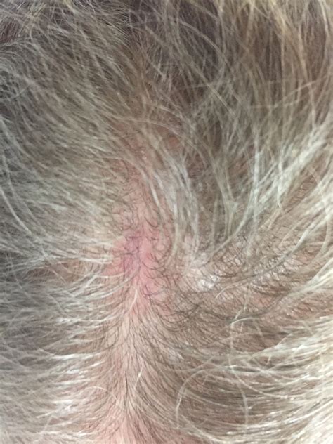 Angiosarcoma Of The Scalp Mimicking An Inflammatory Scarring Alopecia And Diagnosed On