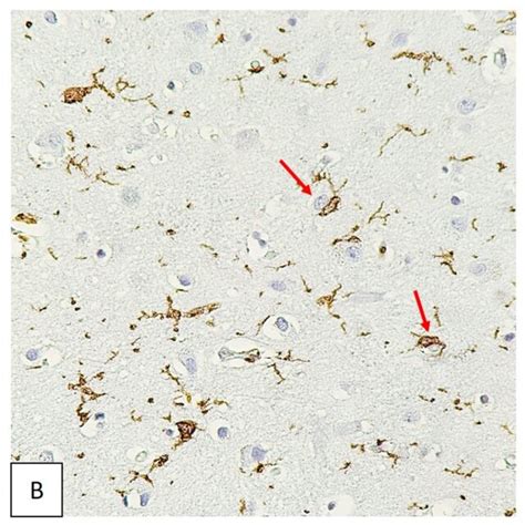 Cerebral Cortex Of Covid 19 Non Survivors Ihc Staining For The