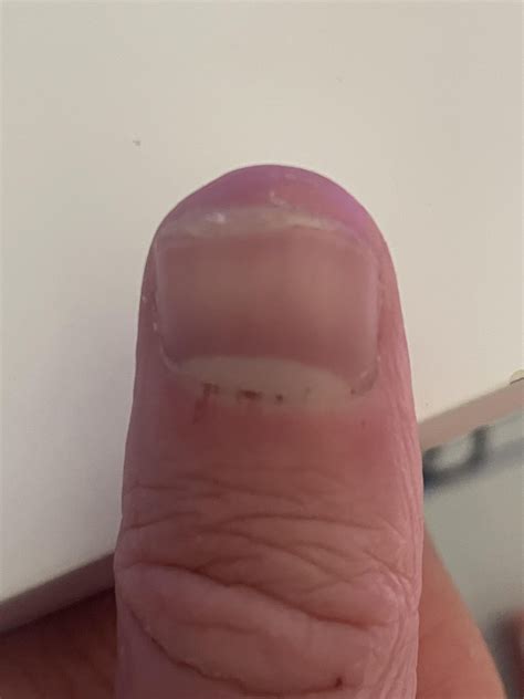 Staining On Thumb Cuticle Concerning R Dermatologyquestions