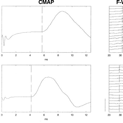 Accuracy Of Distal Motor Latency In Median Neuropathy At The Wrist