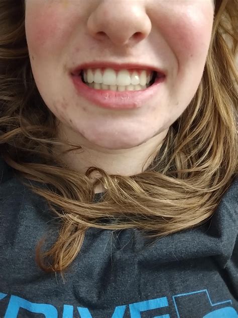 Hemimandibular Hyperplasia R Jawsurgery