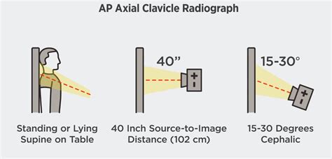 Clavicle X Ray Positioning In Radiography Cracking The Code Hsin Film