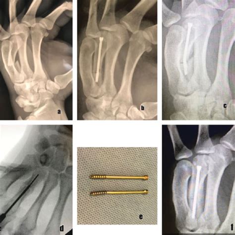 A Preoperative Image Showing A Single Mid Diaphyseal Fracture Of The Download Scientific