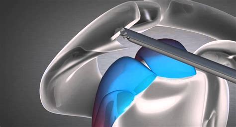 Arthroscopic Acromioplasty Indication And Technique American Sports Medicine Institute