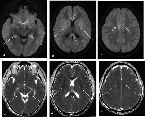 Axial Mri Images Diffusion Weighted Images Dwi Long B Value 1000