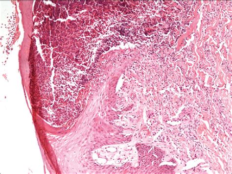 Papulonecrotic Tuberculid Pnt Manifesting As Koebner Phenomenon