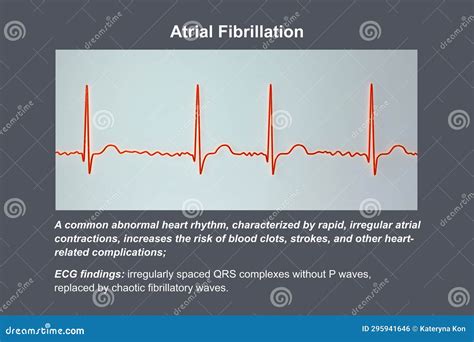 Ecg In Atrial Fibrillation 3d Illustration Stock Illustration