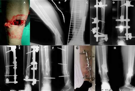 Open Segmental Tibial Shaft Fracture Treated By External Fixation Download Scientific Diagram