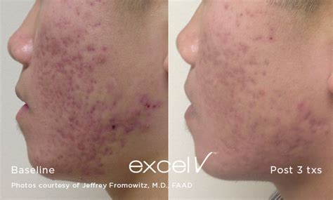 Excel V Before And After Photos San Ramon Dr William Ting