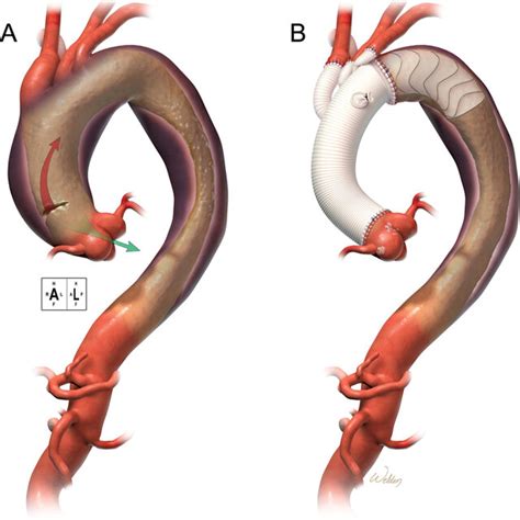 The Modified Cabrol Shunt Between The Perigraft Space To Right Atrial Download Scientific