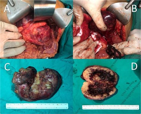 The Jejunal Gist Was Bluntly Dissected From Pancreas A And B The