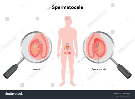 Spermatocele Testicular Disease Man Reproductive Health Stock Vector Royalty Free 2587525365