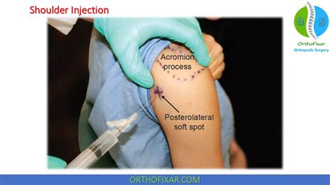Anterior Shoulder Injection Summary Of Pain Injections 10612802x