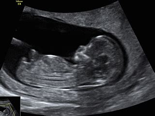 Chographie De Datation Imagerie De La Femme