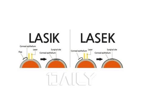 데일리 내게 맞는 시력교정술은 라식과 라섹의 차이점 건강 시력교정술 시력 교정술 라식 라섹 라식수술 라섹수술 라식라섹차이점 라식라섹차이 시력교정수술
