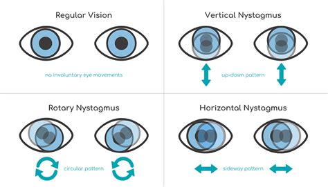 Nystagmus