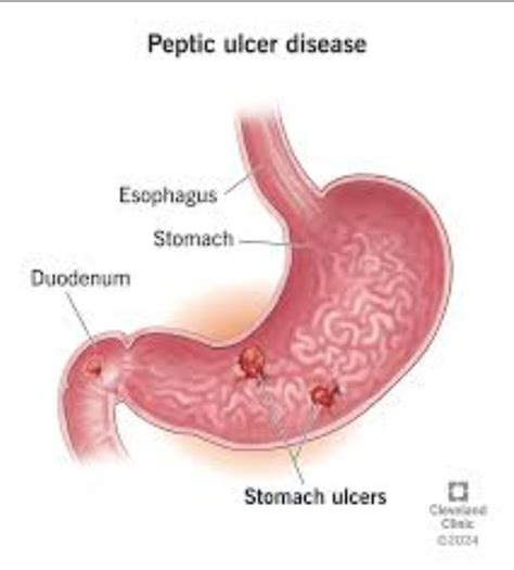 Dr Acid Peptic Disease Apd 🩺 What Is Acid Peptic Disease Acid Peptic Disease Happens When