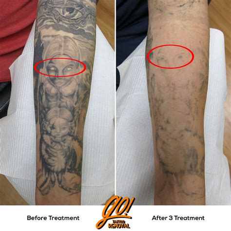 Tattoo In White Ink