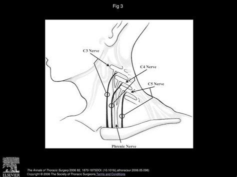 What Are The Accessory Phrenic Nerve At Liam Threlfall Blog