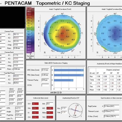Preoperative Topometric Map Of A Keratoconus Patient Showing