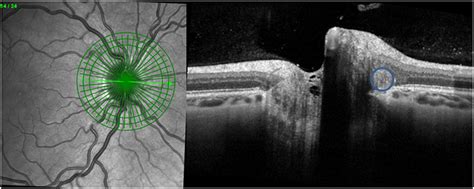 Are Peripapillary Hyperreflective Ovoid Mass Like Structures With An