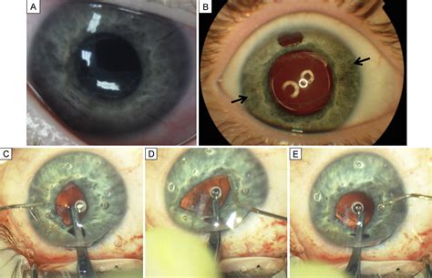 References In Retropupillary Artisan Intraocular Lens Implantation In My XXX Hot Girl