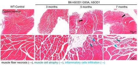 Breaking Barriers Advancing Gene Therapies For Amyotrophic Lateral Sclerosis