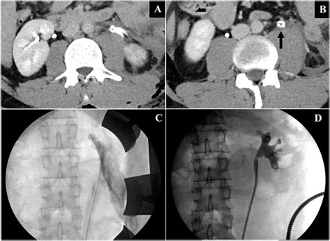 A Delayed Excretory Phase Ct Scan With Contrast Material Extravasation Download Scientific