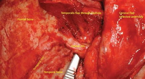 Intraoperative Picture Showing Coronal Flap Reflected Anteriorly And