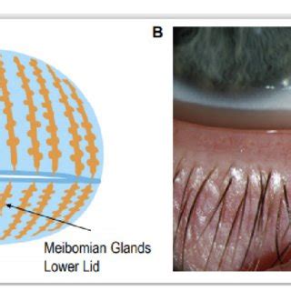 Meibomian Gland Dysfunction Is A Leading Cause Of Evaporative Ded